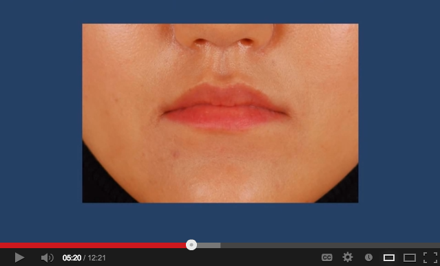 “Smile Lipt” surgery promises to make you smile even if you don’t want ...