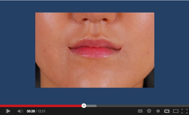 “Smile Lipt” surgery promises to make you smile even if you don’t want ...