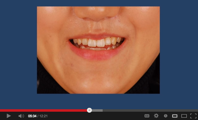 “Smile Lipt” surgery promises to make you smile even if you don’t want ...