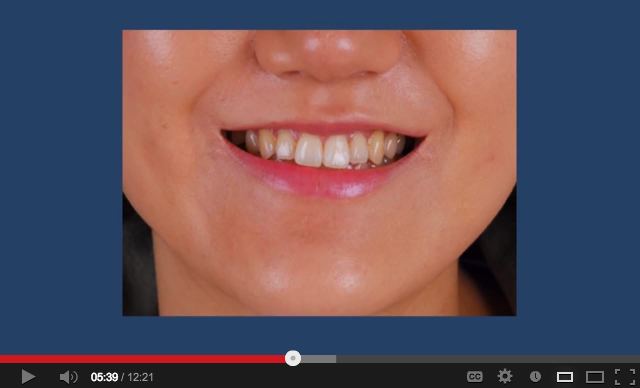 “Smile Lipt” surgery promises to make you smile even if you don’t want ...