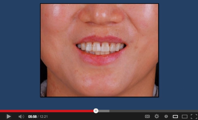 “Smile Lipt” surgery promises to make you smile even if you don’t want ...