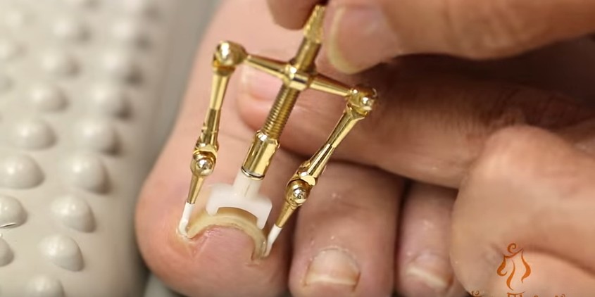 Amazing tool fixes ingrown nails, looks like a torture device ...