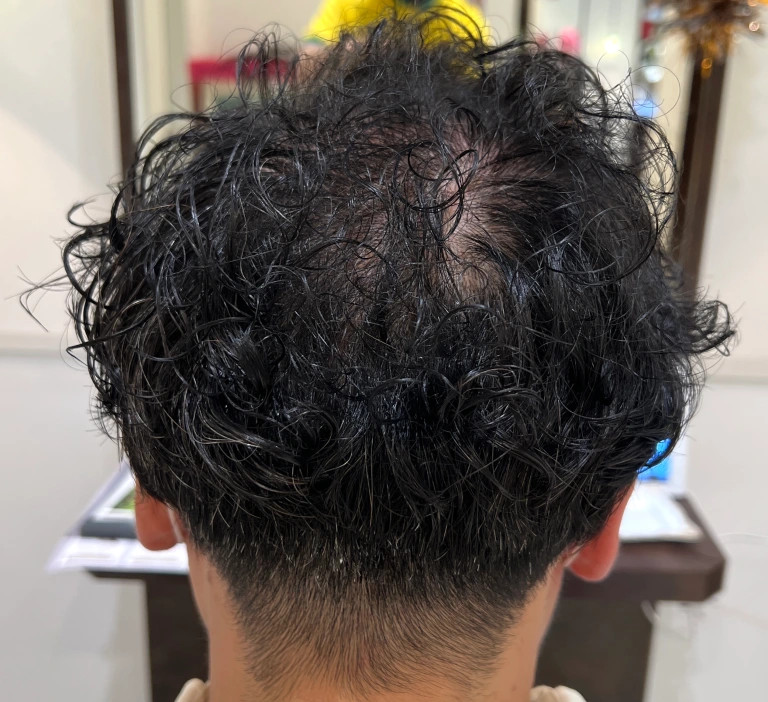 Does getting a perm help hide the thinning hair spots on your head? We ...
